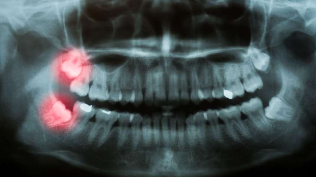 Van Nuys, CA, Wisdom Teeth Removal: Before, During, and After | Oral ...